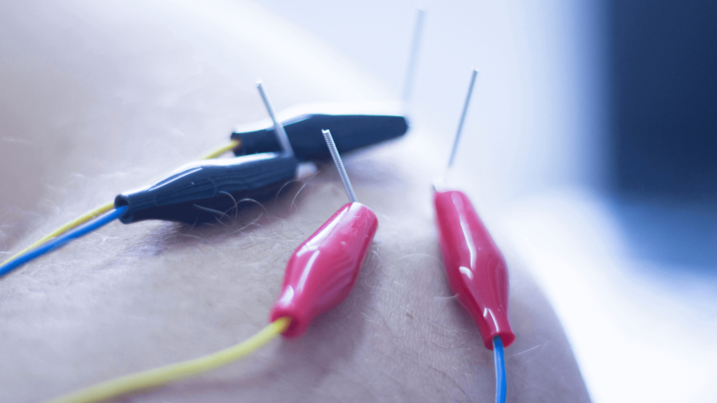 Unlocking the Benefits of Dry Needling: A Guide for Active Adults and ...